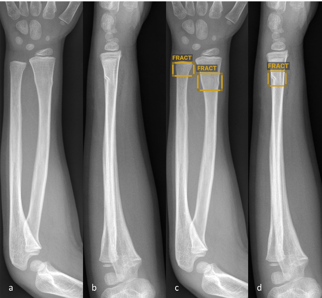 L'IA dans le diagnostic de la fracture pédiatrique | FMH